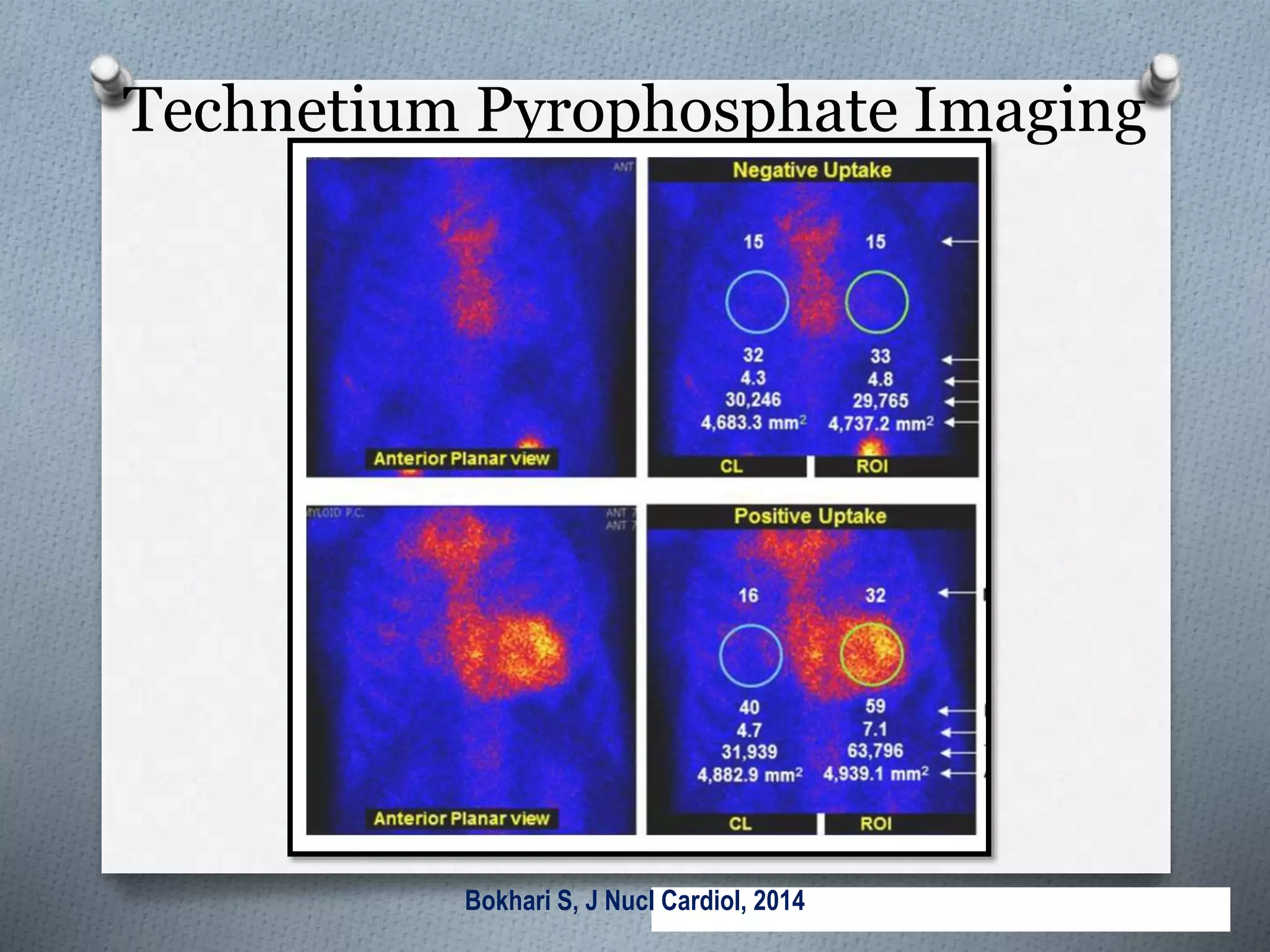 Radionuclide Imaging of Cardiac Amyloidosis and SarcoidosisFELLOWS ...