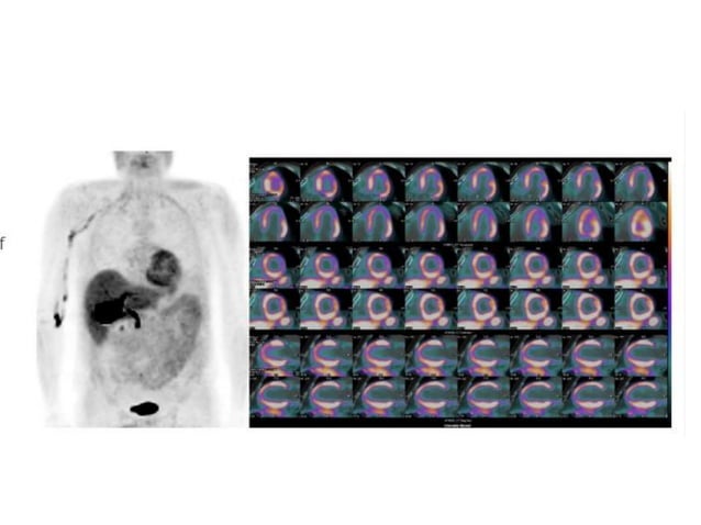 Radionuclide Imaging of Cardiac Amyloidosis and SarcoidosisFELLOWS LECTUREupdated.pptx