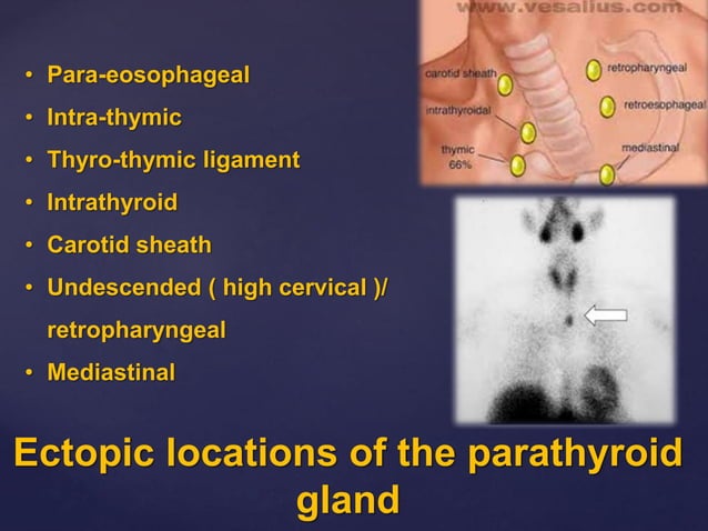 Radionuclide imaging of parathyroid glands | PPTX