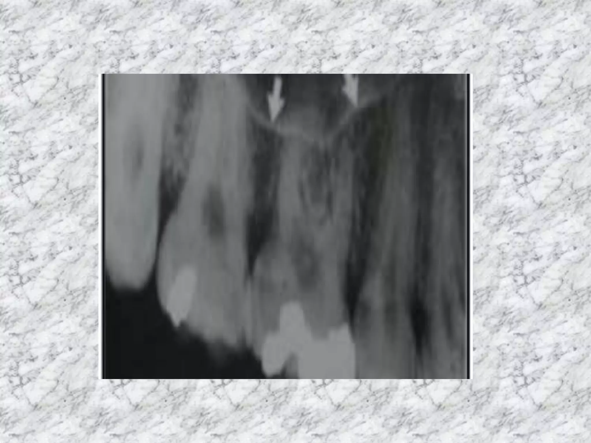 Radiopaque Lesions | PPTX