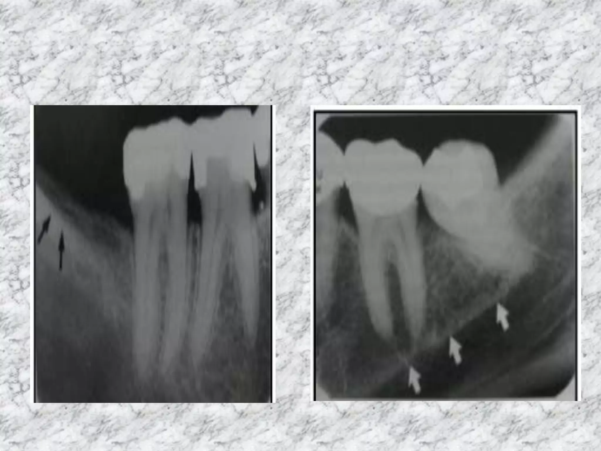 Radiopaque Lesions | PPTX