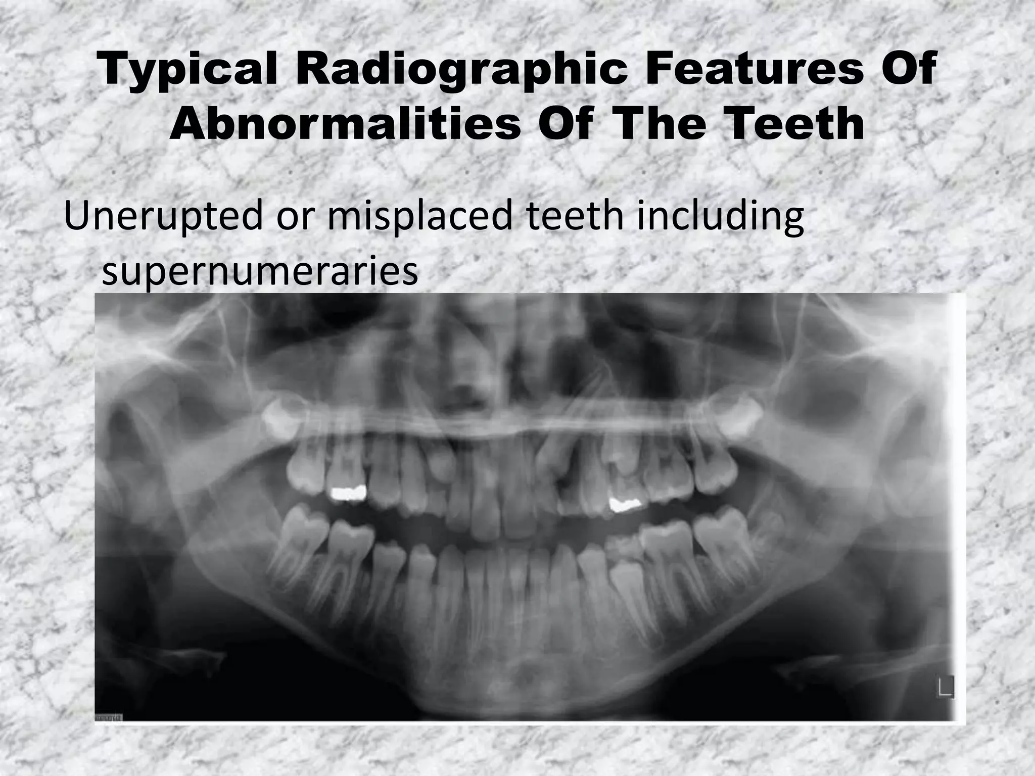 Radiopaque Lesions | PPTX