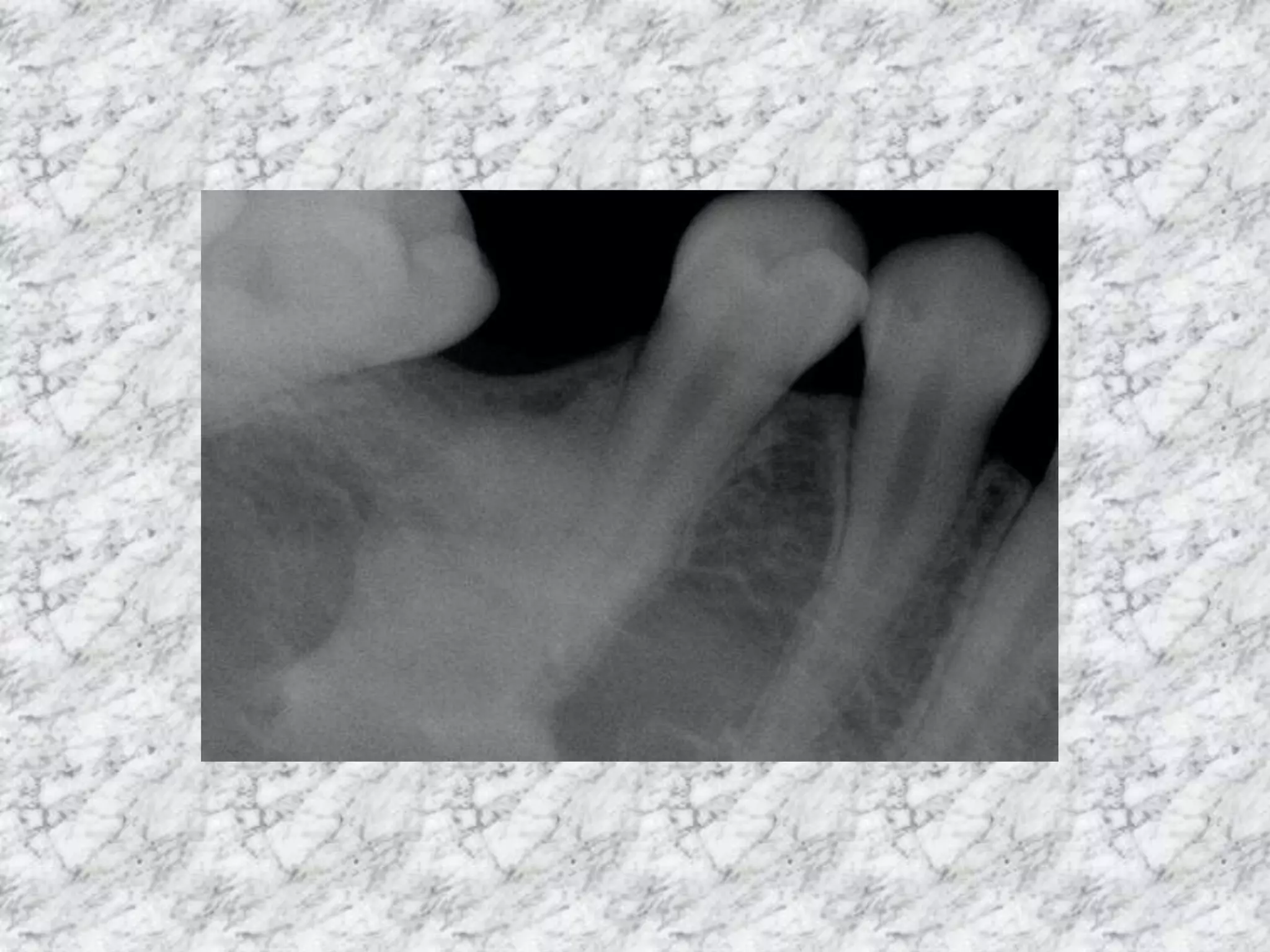 Radiopaque Lesions | PPTX