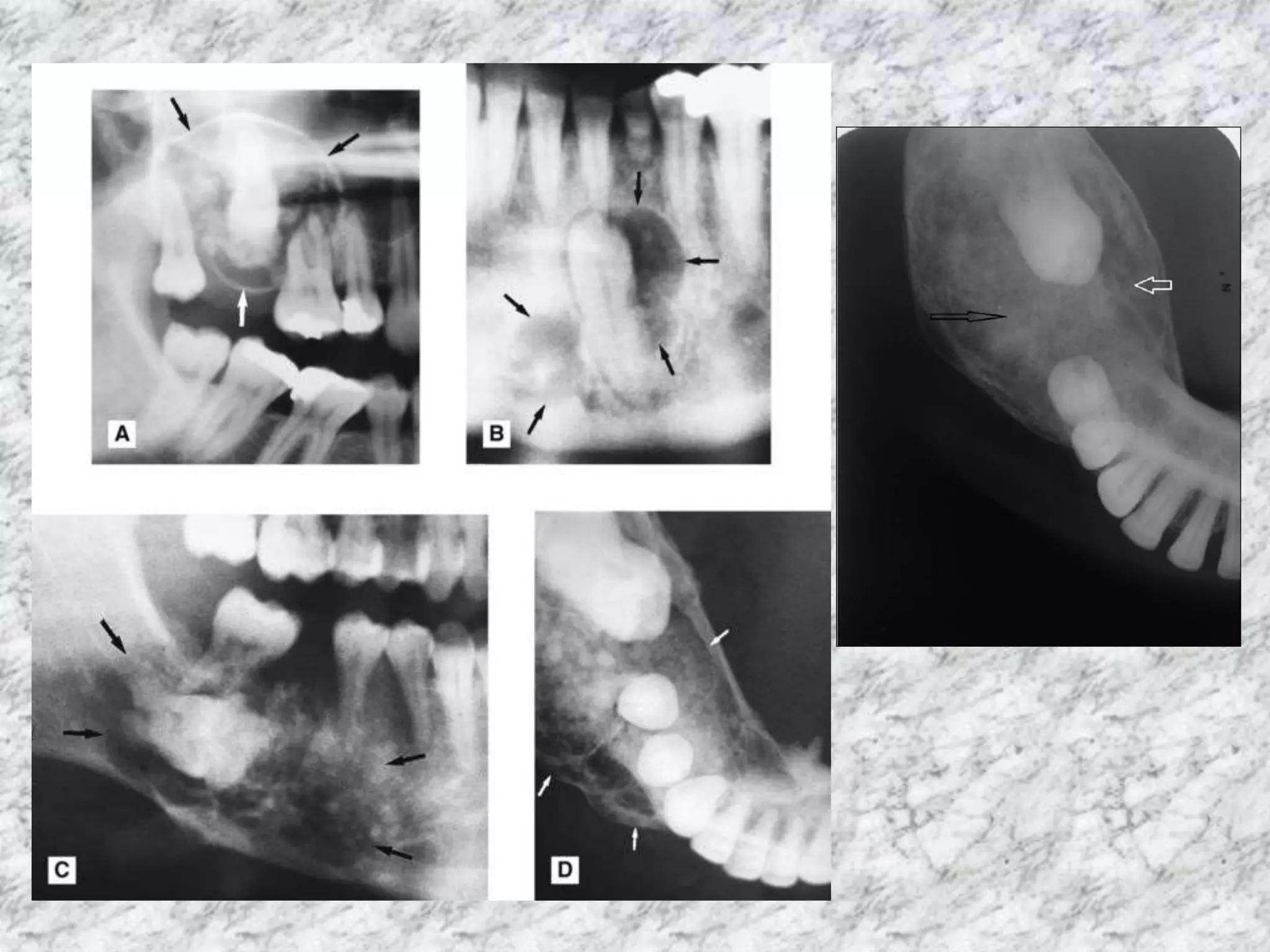 Radiopaque Lesions | PPTX
