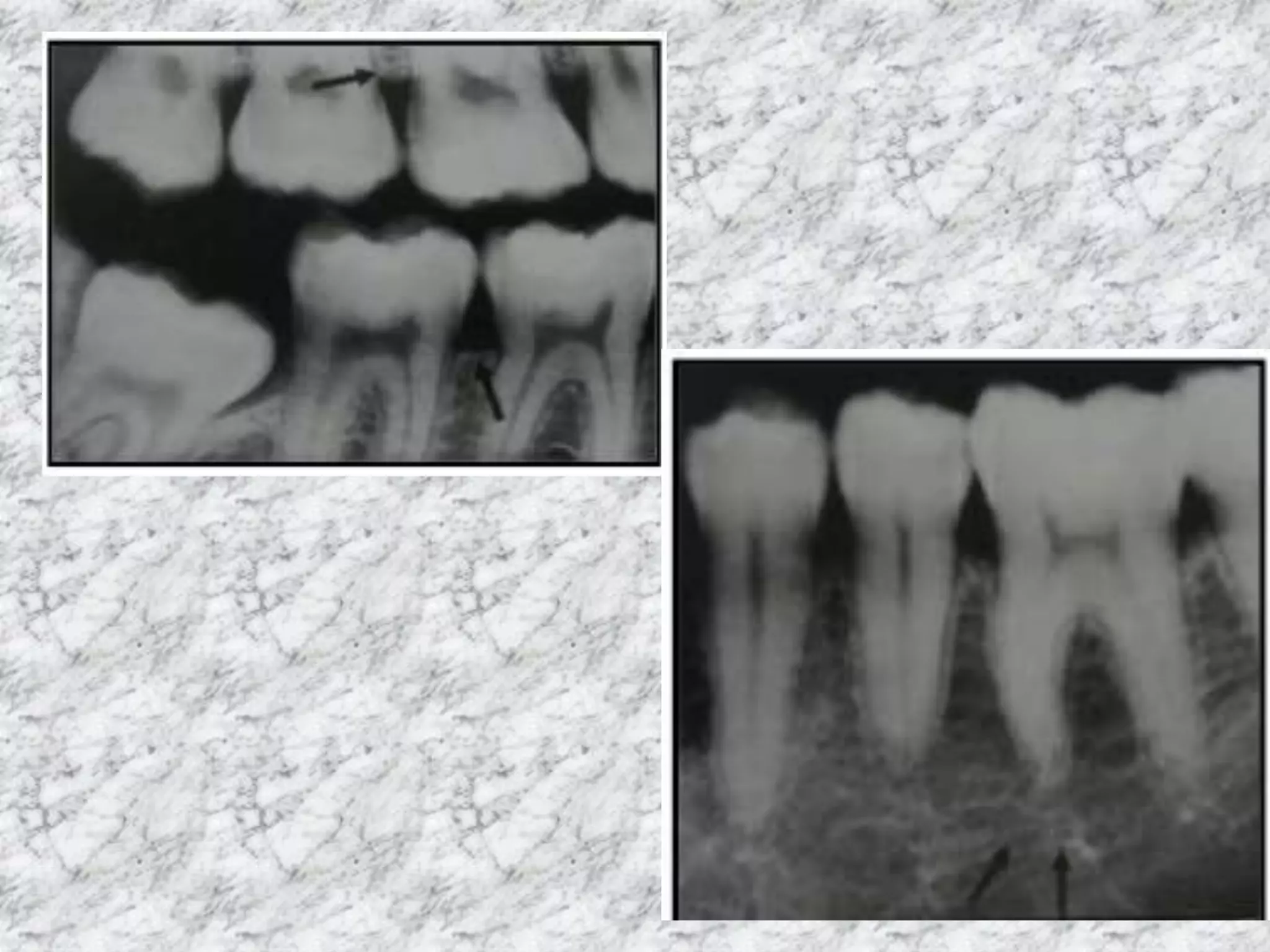 Radiopaque Lesions | PPTX