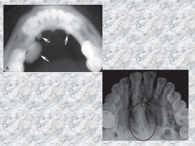 Radiopaque Lesions | PPTX | Dental Health | Diseases and Conditions