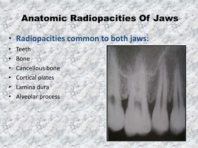 Radiopaque Lesions | PPTX | Dental Health | Diseases and Conditions