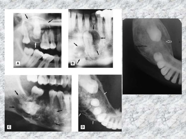 Radiopaque Lesions | PPTX | Dental Health | Diseases and Conditions