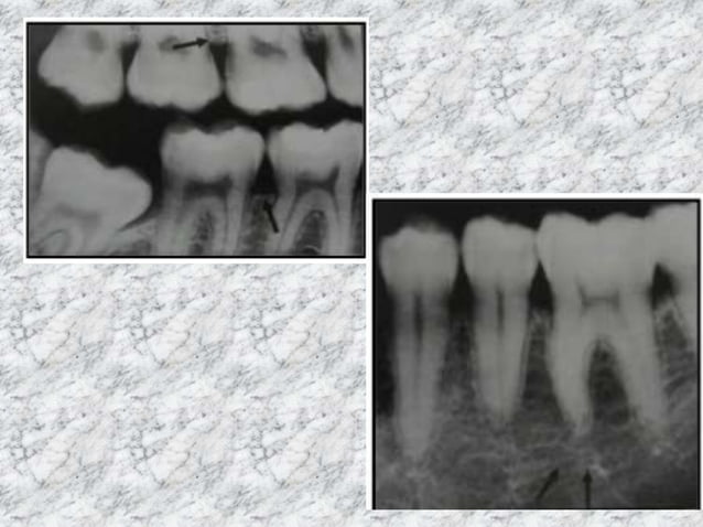Radiopaque Lesions | PPTX | Dental Health | Diseases and Conditions