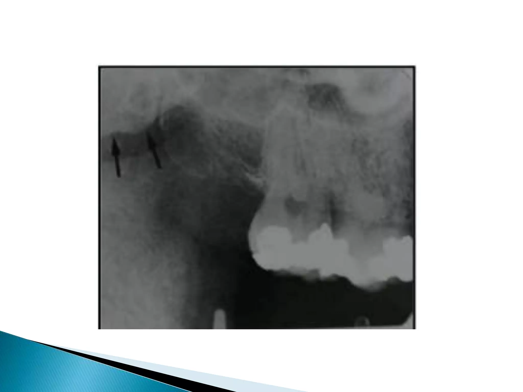 Radiopacities of jaws | PPTX