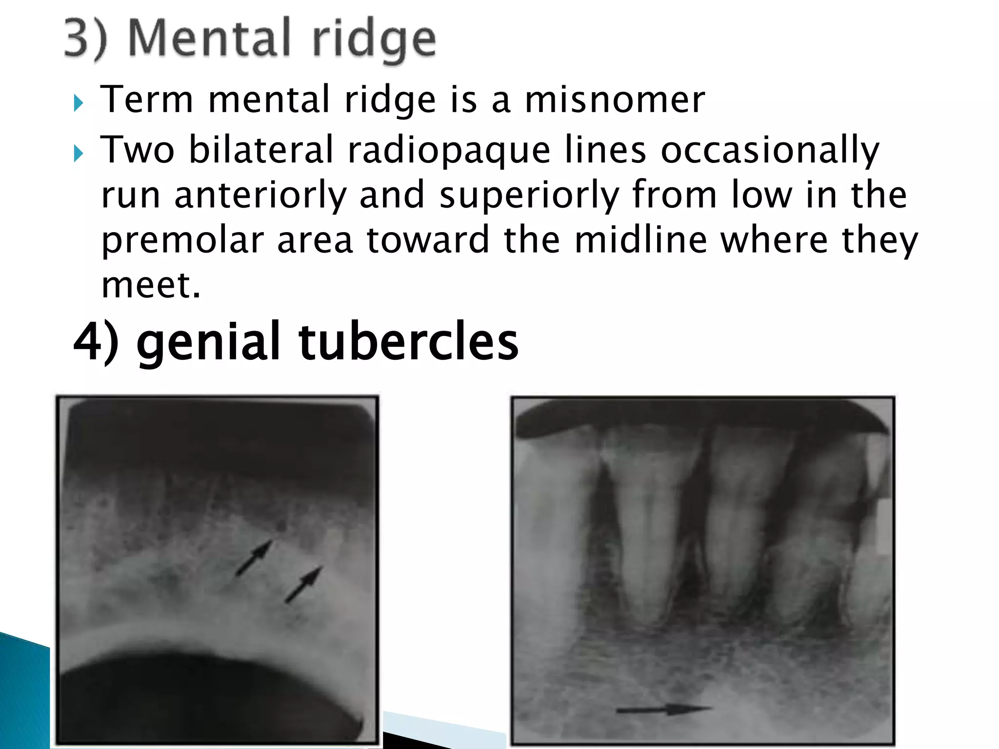 Radiopacities of jaws | PPTX