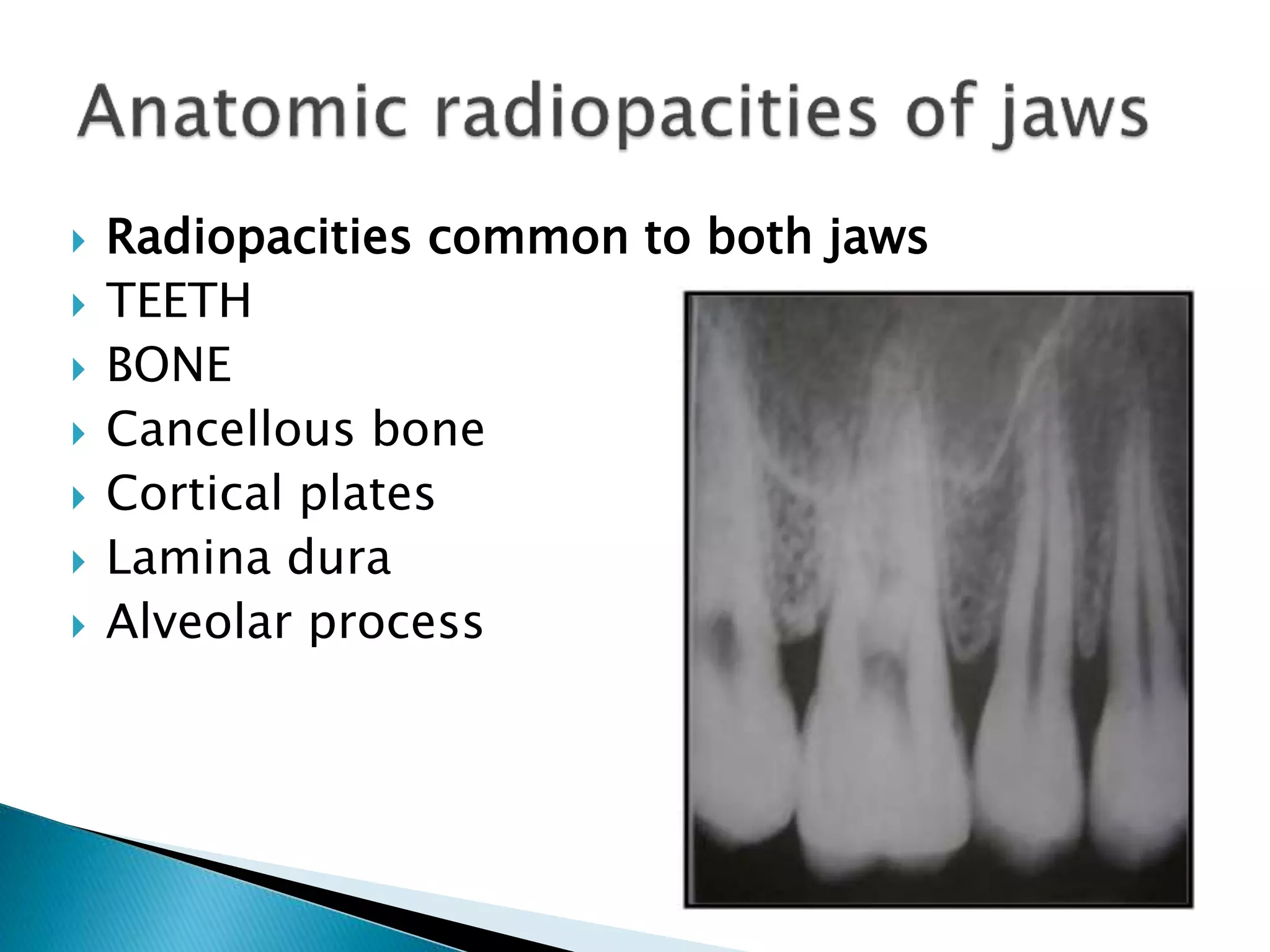 Radiopacities of jaws | PPTX