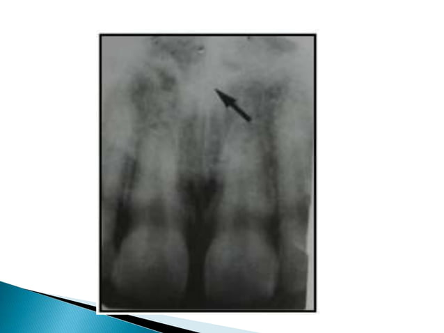 Radiopacities of jaws | PPTX | Bone and Joint Conditions | Diseases and ...
