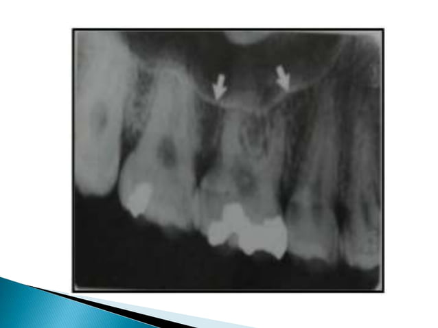 Radiopacities of jaws | PPTX | Bone and Joint Conditions | Diseases and ...