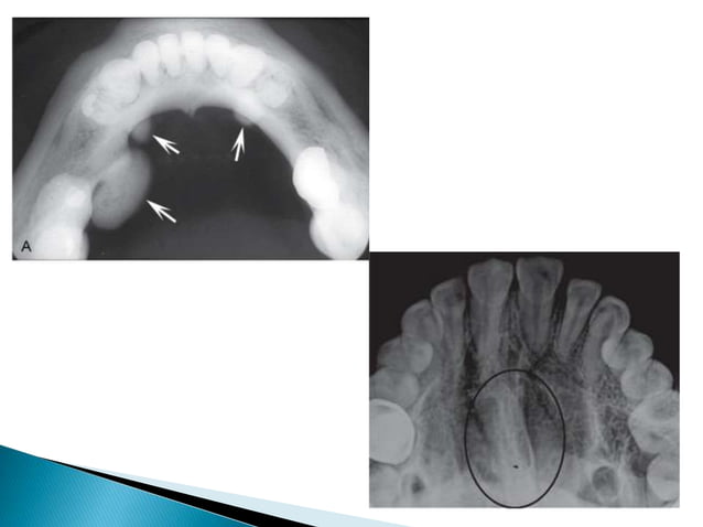 Radiopacities of jaws | PPTX | Bone and Joint Conditions | Diseases and ...