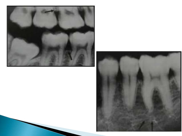 Radiopacities of jaws | PPTX | Bone and Joint Conditions | Diseases and ...