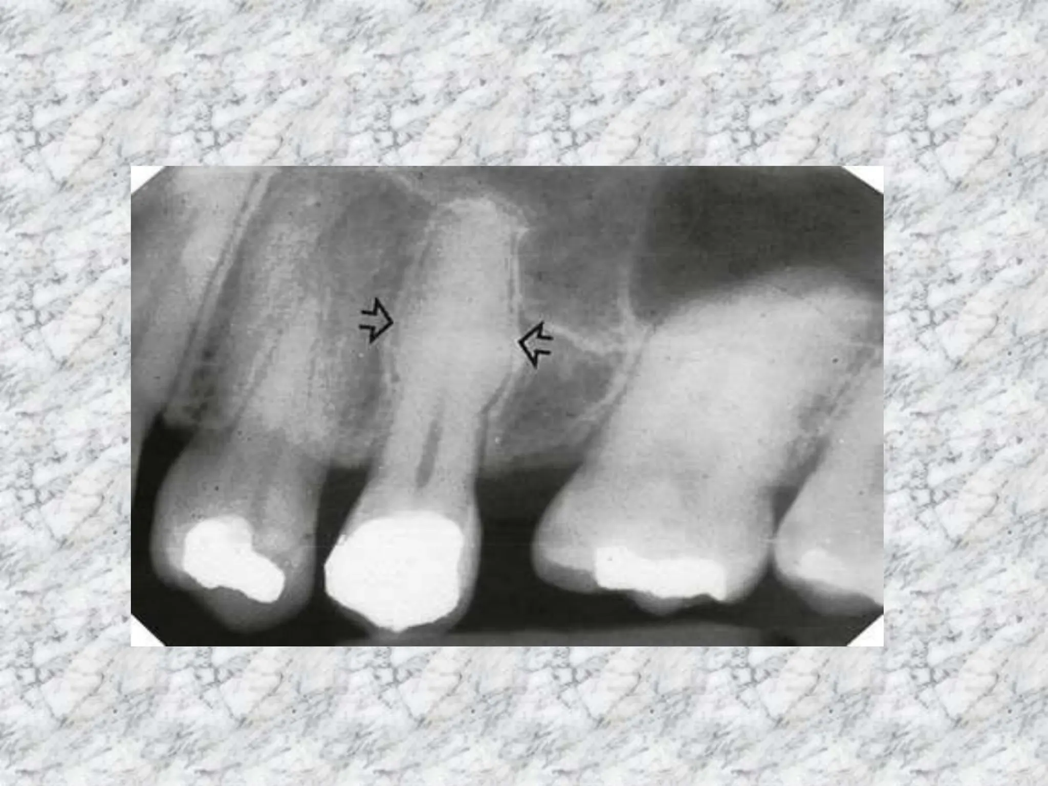 radiopacity lesions : radiology lecture. | PPTX