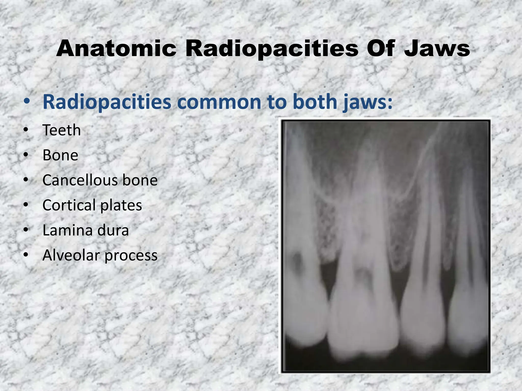 radiopacity lesions : radiology lecture. | PPT