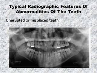 radiopacity lesions : radiology lecture. | PPTX | Bone and Joint ...