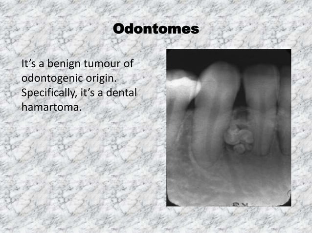 radiopacity lesions : radiology lecture. | PPT