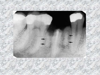 radiopacity lesions : radiology lecture. | PPTX | Bone and Joint ...