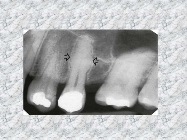 radiopacity lesions : radiology lecture. | PPTX | Bone and Joint ...