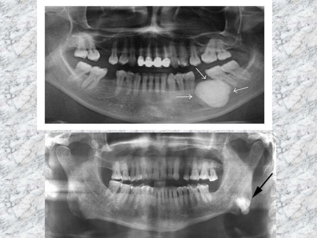 radiopacity lesions : radiology lecture. | PPTX | Bone and Joint ...