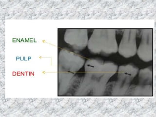 radiopacity lesions : radiology lecture. | PPTX | Bone and Joint ...