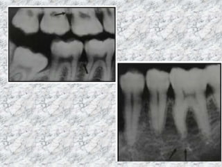 radiopacity lesions : radiology lecture. | PPTX | Bone and Joint ...