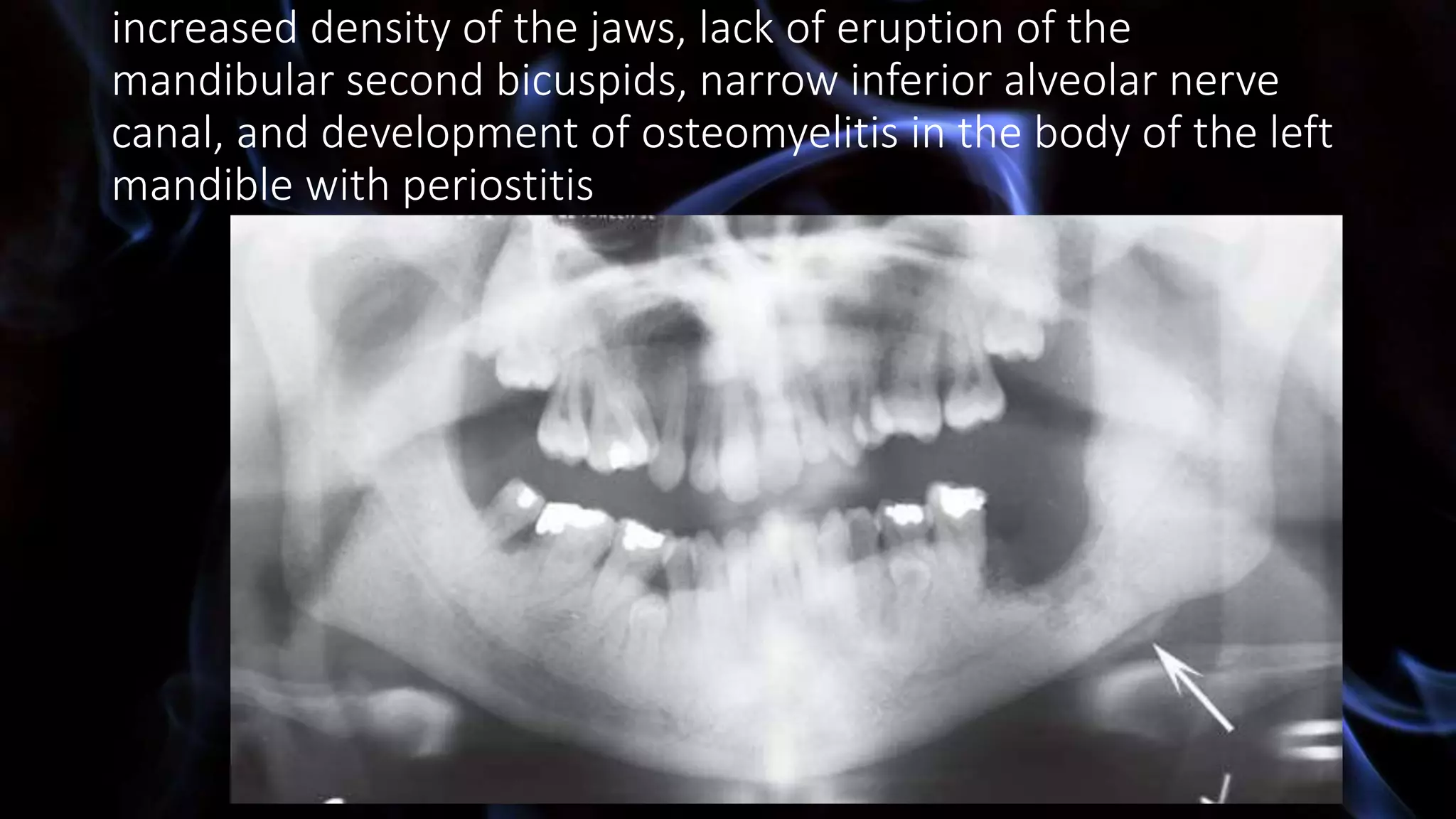 Systemic Diseases Manifested in the Jaws | PPTX