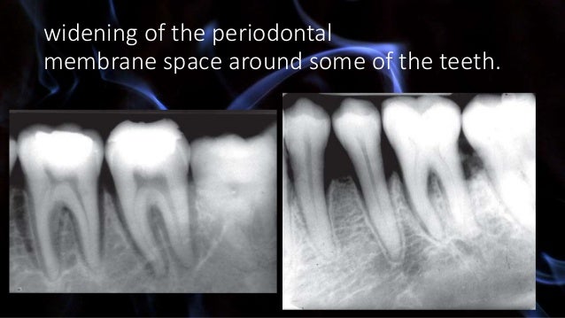 Systemic Diseases Manifested In The Jaws