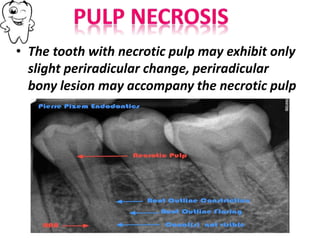 Radio pulp diseases | PPTX