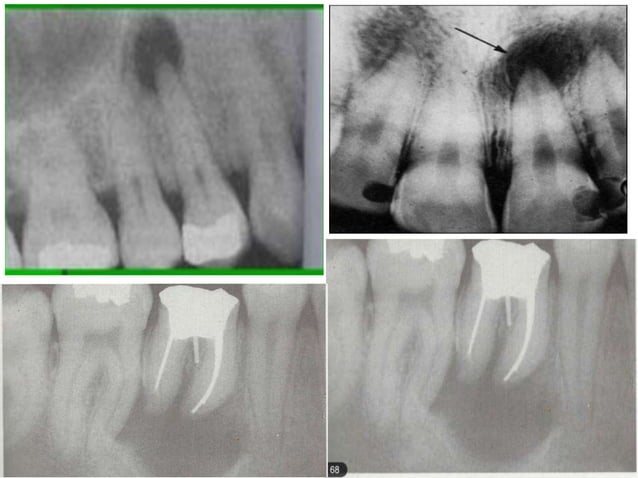 Radio pulp diseases | PPTX | Dental Health | Diseases and Conditions