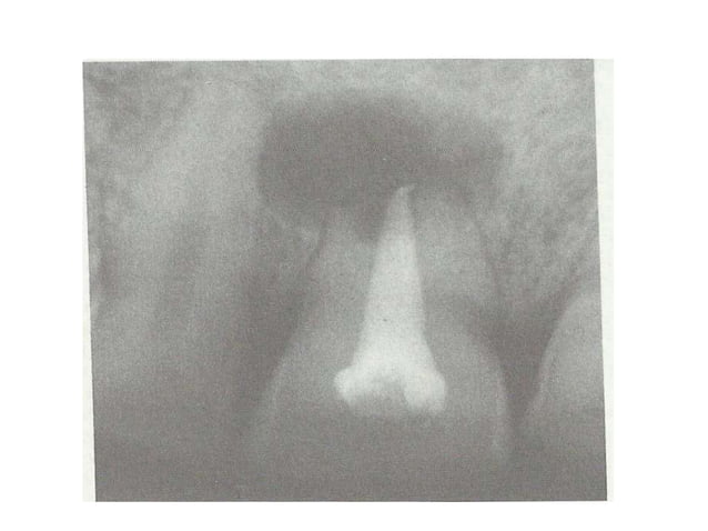 Radio pulp diseases | PPTX | Dental Health | Diseases and Conditions