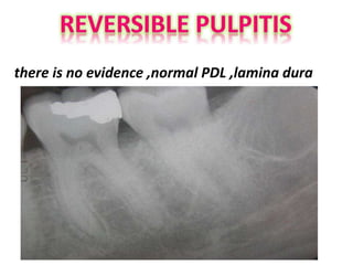 Radio pulp diseases | PPT
