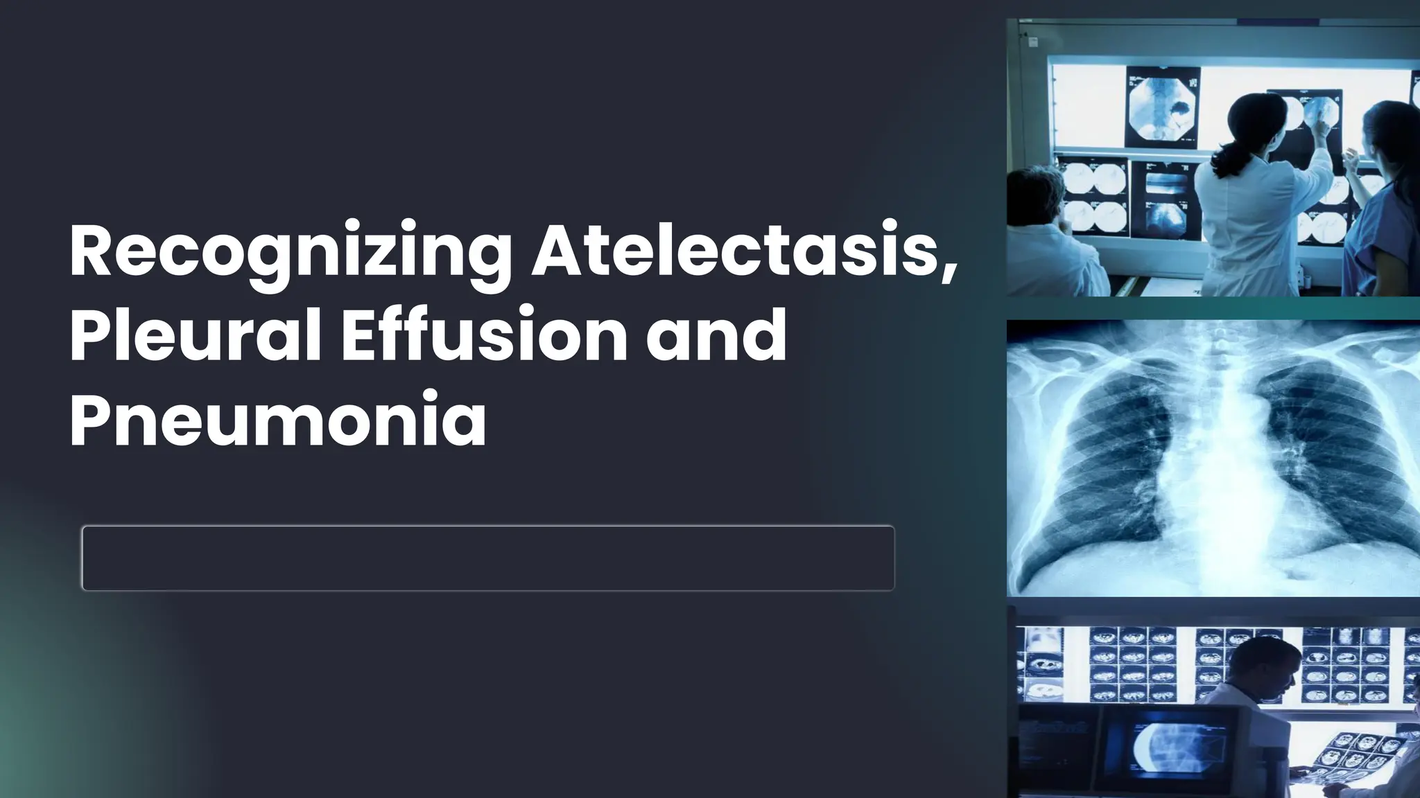 Recognizing Atelectasis, Pleural Effusion and Pneumonia | PDF