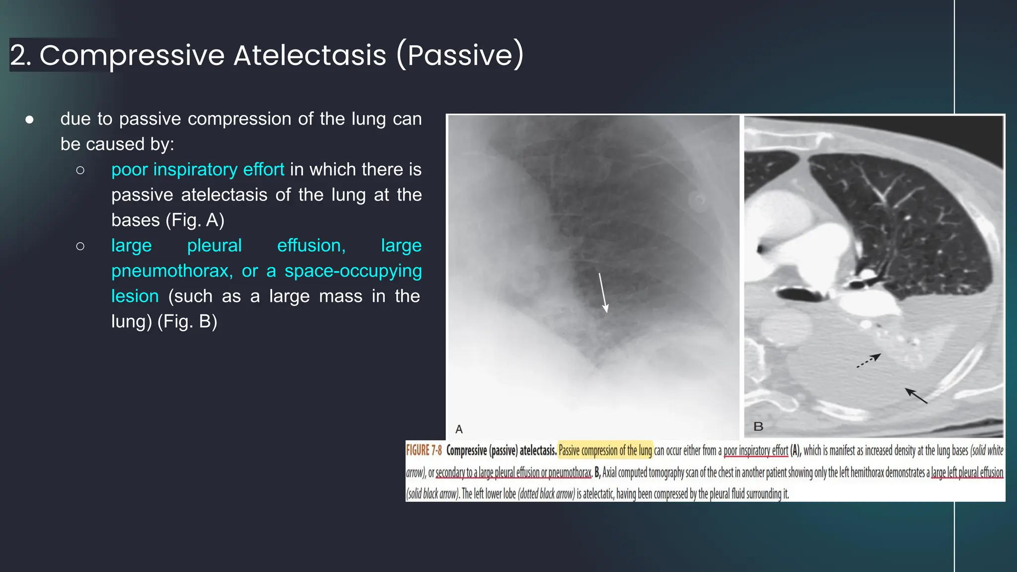 Recognizing Atelectasis, Pleural Effusion and Pneumonia | PDF