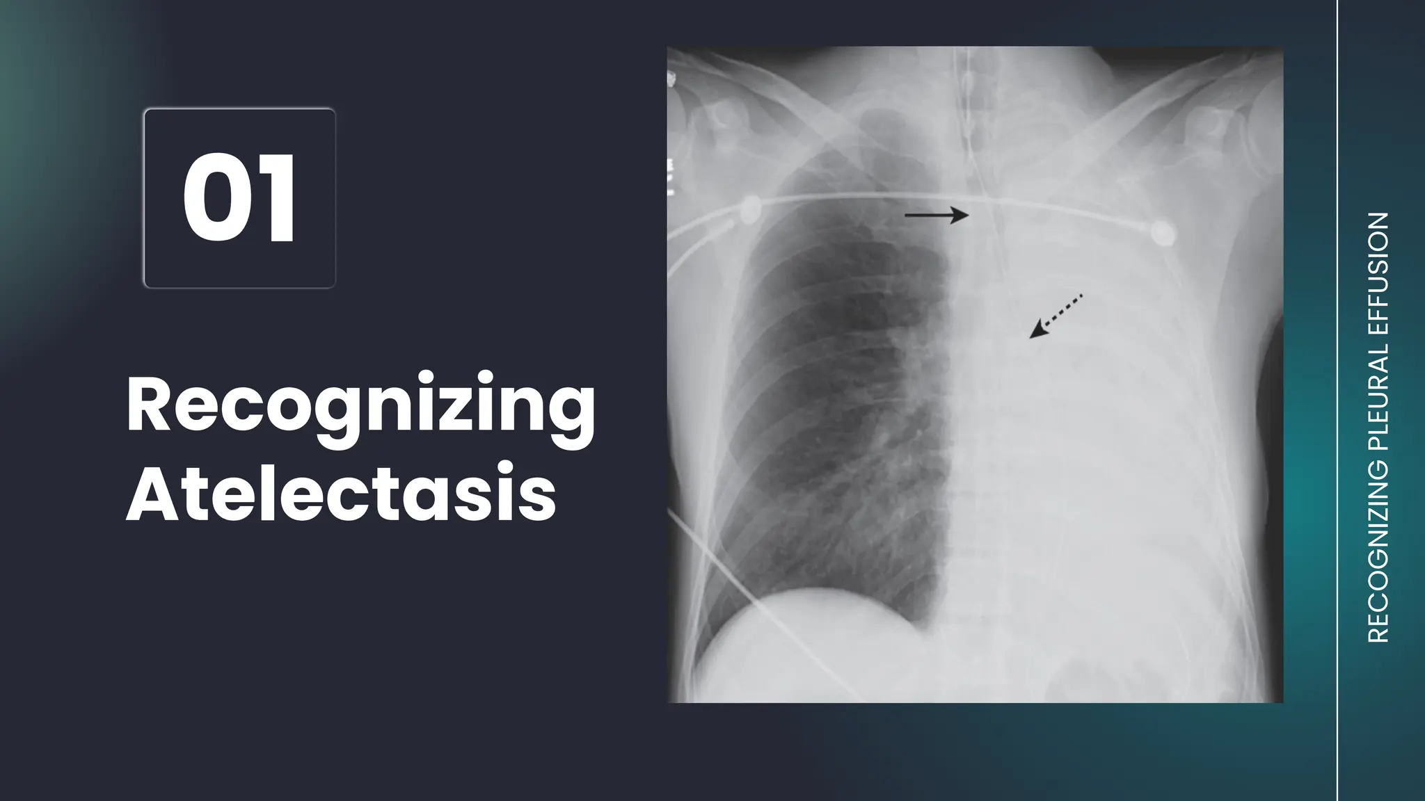 Recognizing Atelectasis, Pleural Effusion and Pneumonia | PDF