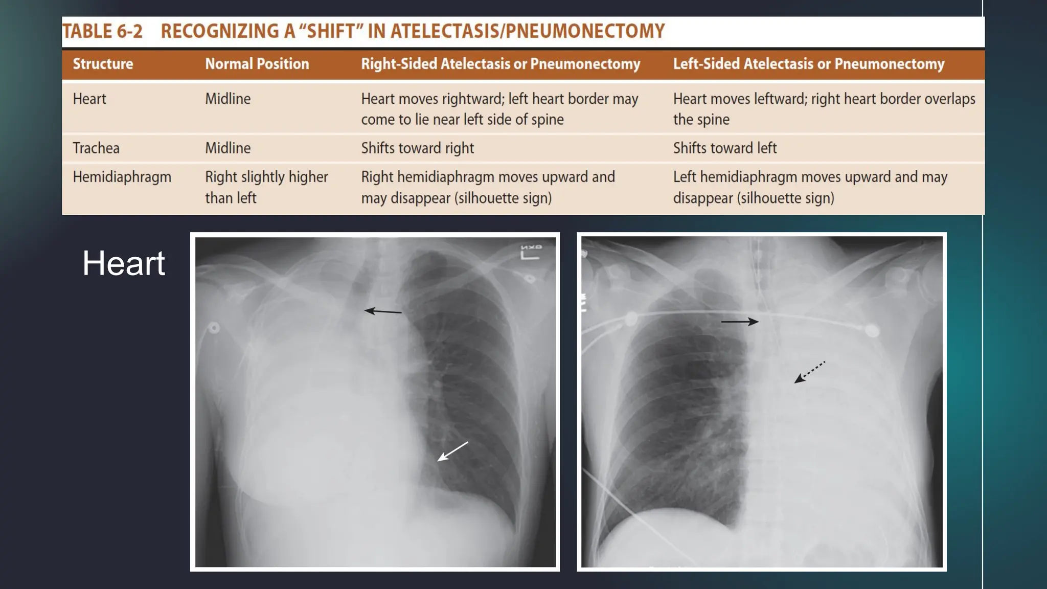 Recognizing Atelectasis, Pleural Effusion and Pneumonia | PDF