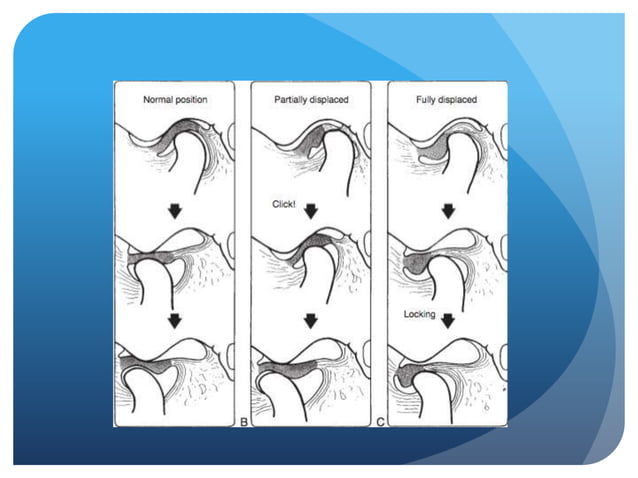Radiographic imaging of TMJ | PPTX | Bone and Joint Conditions ...