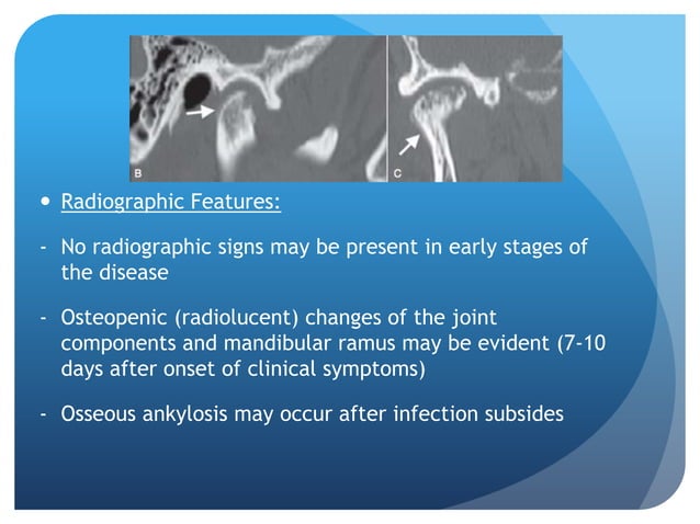 Radiographic imaging of TMJ | PPTX | Bone and Joint Conditions ...