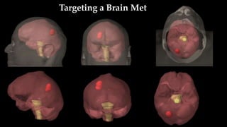 Radiosurgery for brain metastases | PPTX