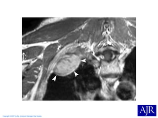 Radiotherapy And Fibromatosis | PPT | Cancer | Diseases and Conditions