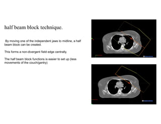 Radiotherapy Breast Cancer | PDF
