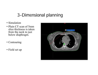 Radiotherapy Breast Cancer | PDF