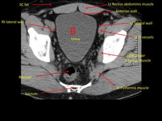 Radiotherapy for bladder cancer part i | PPTX