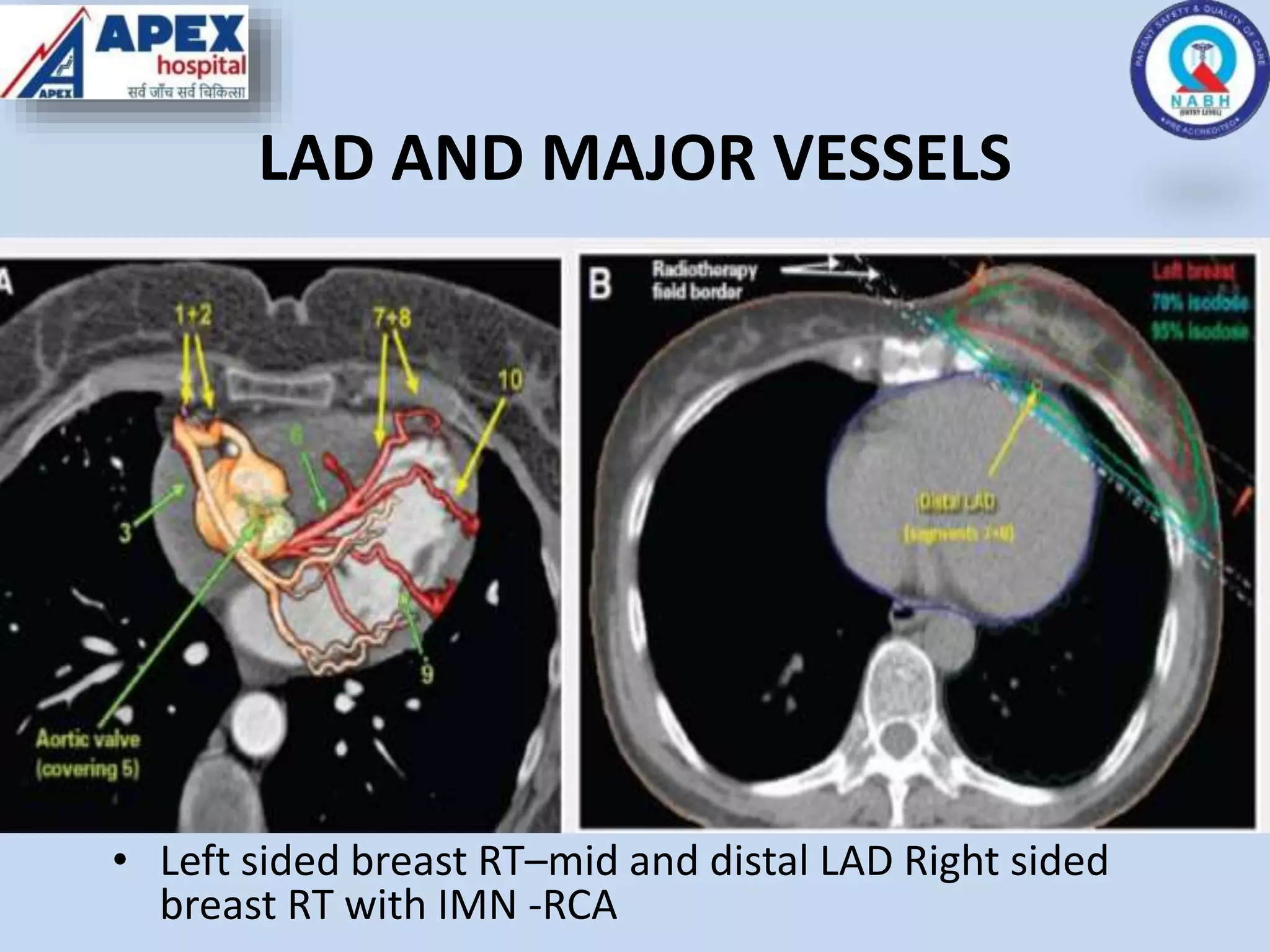 RADIOTHERAPY IN CARCINOMA BREAST (EARLY AND LOCALLY ADVANCED) | PPTX