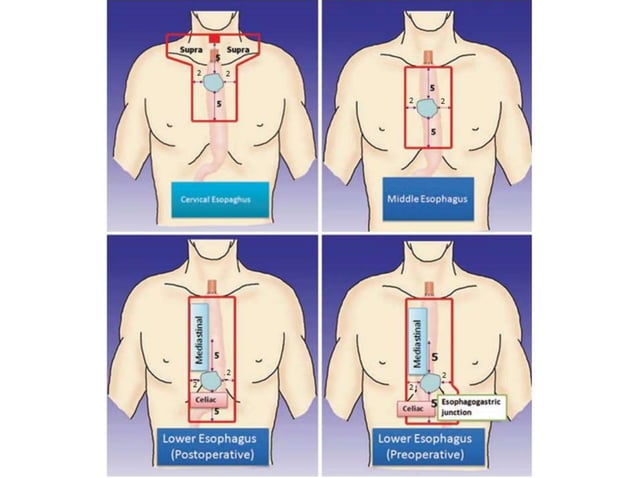 Radiotherapy in ca esophagus | PPTX | Cancer | Diseases and Conditions