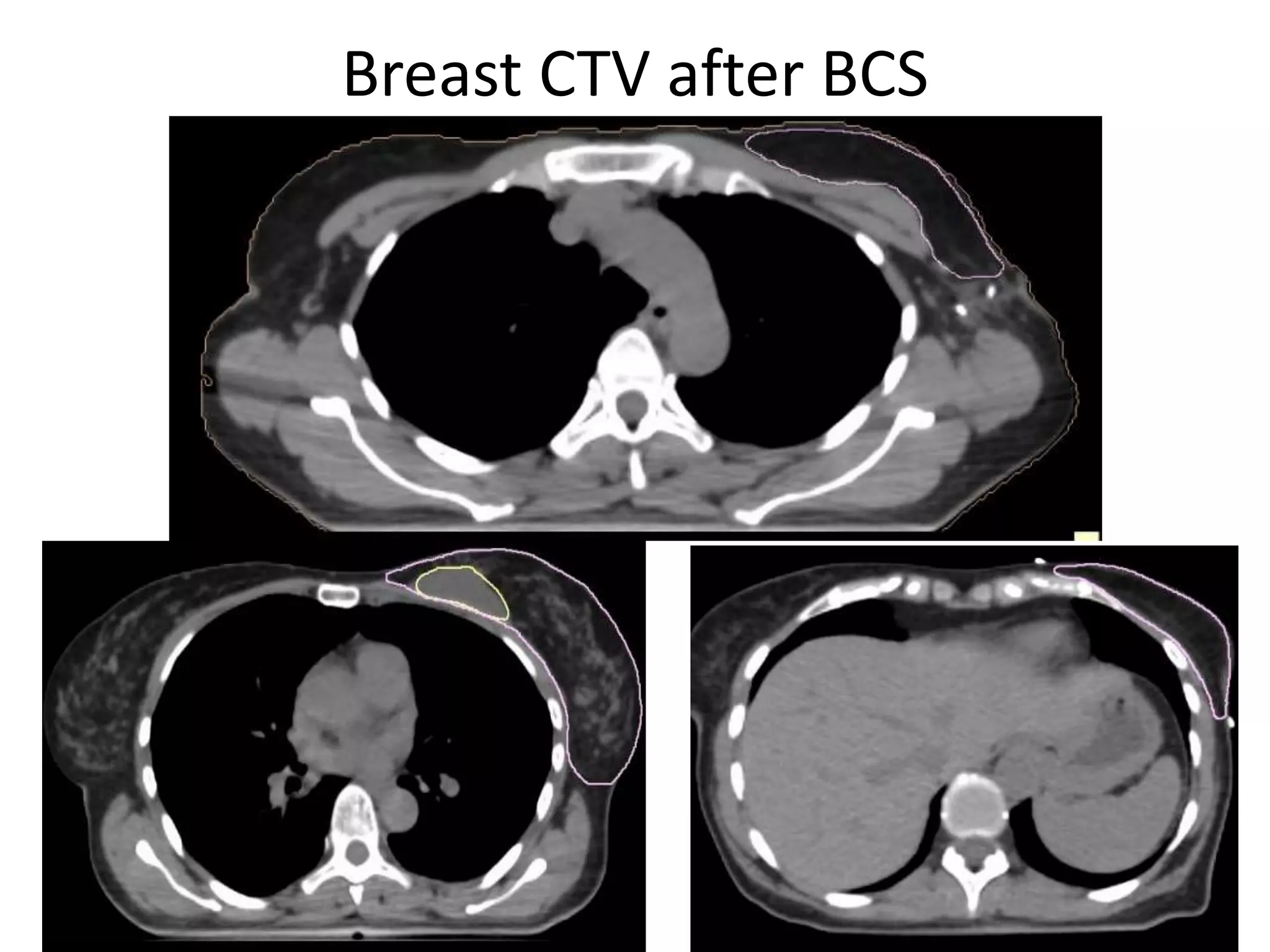 Radiotherapy in carcinoma breast | PPTX