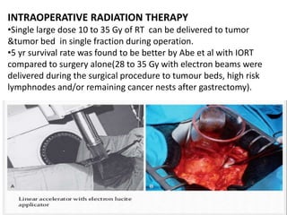 Radiotherapy in carcinoma stomach - current scenario | PPTX